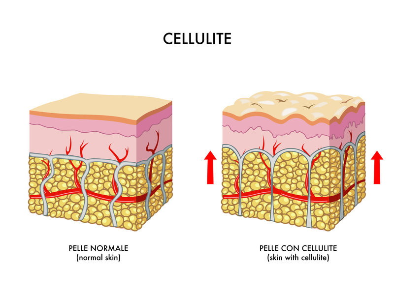 Éliminer votre cellulite avec le régime hypotoxique – Avoir Une Belle Peau